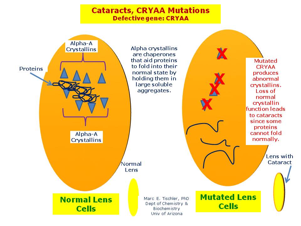 Cataracts, CRYAA Mutations | Hereditary Ocular Diseases